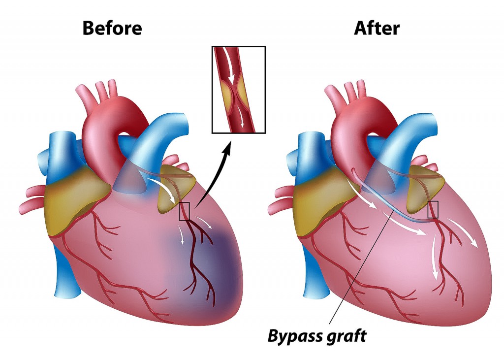 coronary artery bypass surgery in Nashik | Dr.Nitin Kochar